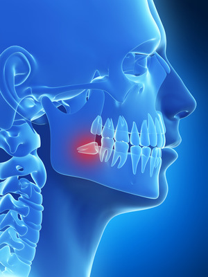 Sideways Wisdom Teeth San Ramon | Oak Ridge Dental